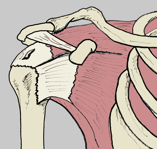 Hombro doloroso (tendinitis del supraespinoso) – Dr. Fernando J ...